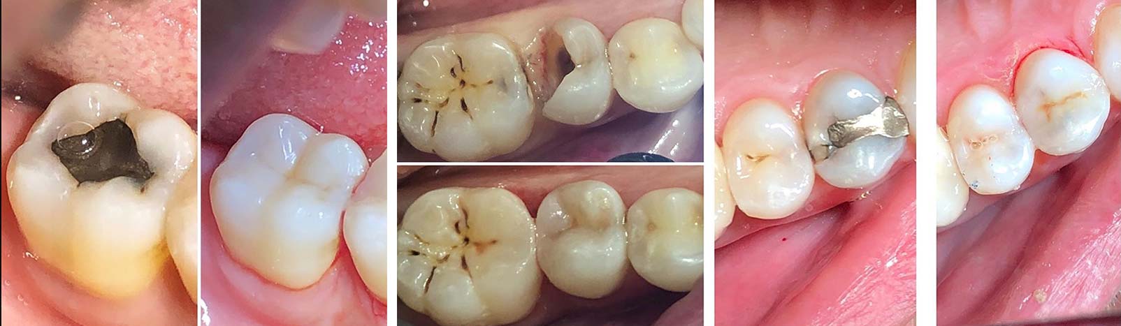 Εμφράξεις δοντιών (σφράγισματα) | Οδοντιατρική κλινική Dental Art Clinic